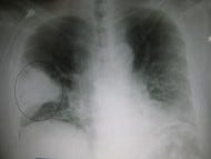 Subglottic suctioning prevents ventilator-associated pneumonia