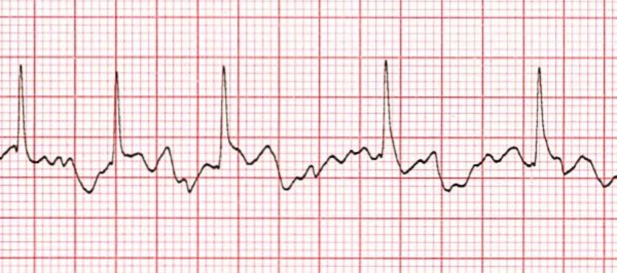 Atrial Fibrillation - by Robert Henson MD - Cardiology 123!