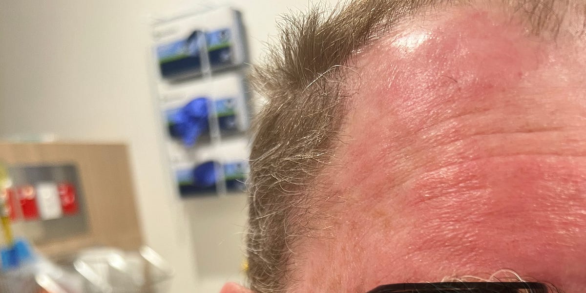 Comments - Peri - Orbital Cellulitis - by Malinda Perera