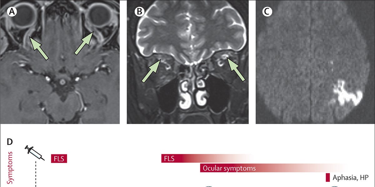 Thrombosis, hypercoagulation, & stroke - by Logos Sympónia