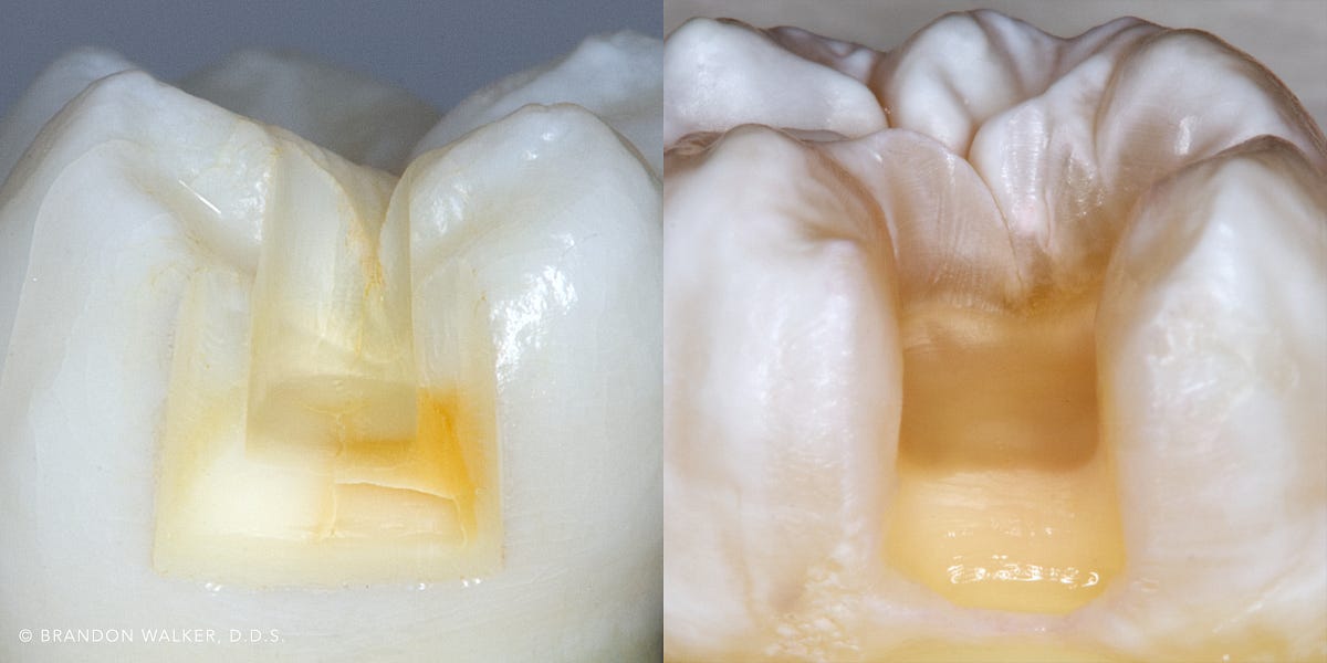 Modern Cavity Preparations - by Brandon Walker, D.D.S.