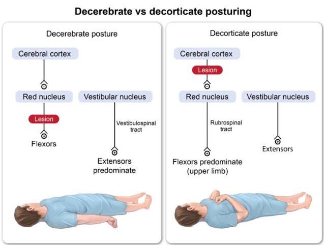Decorticate vs Decerebrate posturing
