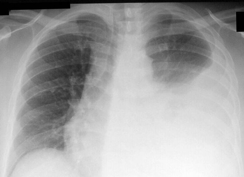 Should pleurodesis or PleurX drain be 1st-line Rx for malignant pleural ...