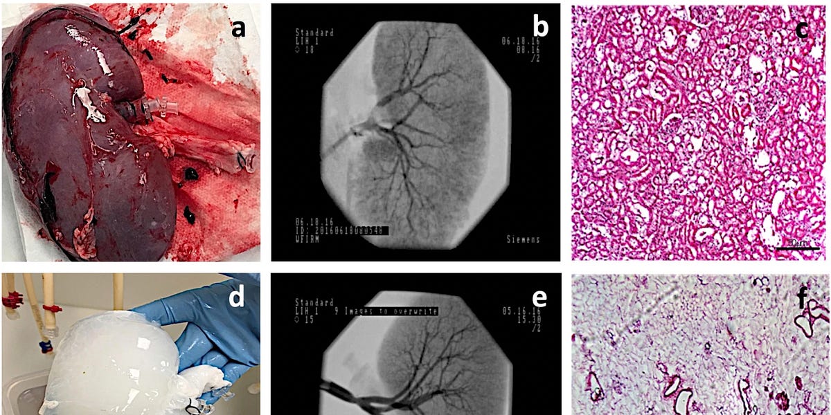 Creating Human Kidneys using Pig Kidneys - by Adaobi