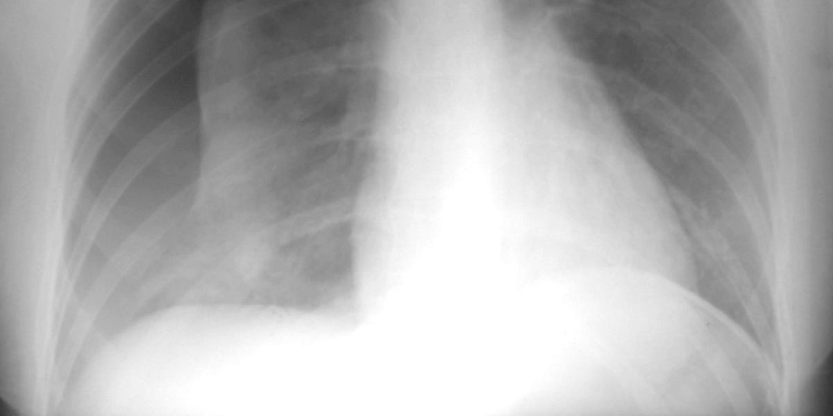 Tracheobronchial rupture - RadNotes