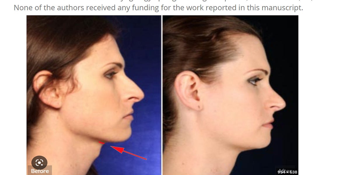 Diagnosis and Management of Vocal Complications after Transgender ...