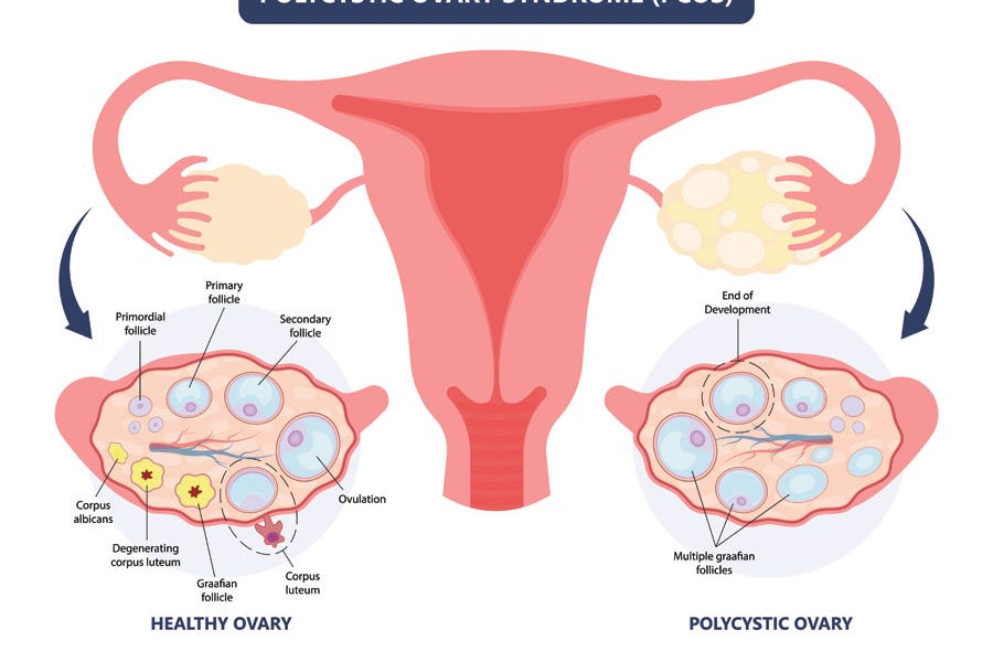 Mengenal Polycystic Ovary Syndrome (PCOS) pada Wanita