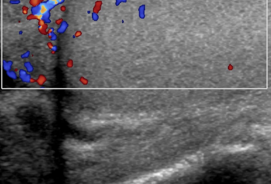 Epididymitis and Epididymo-orchitis - by Alexander Baxter