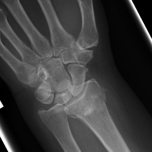 Distal radial fractures - by Alexander Baxter - RadNotes