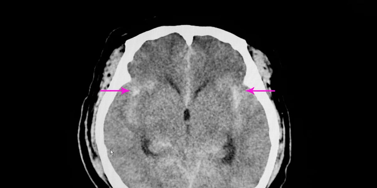 Blood transfusion targets in acute brain injury