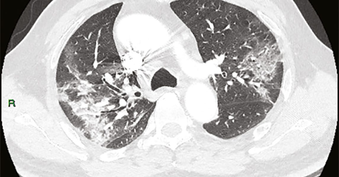 Isolation of SARS-CoV-2/Covid-19 first patient in Australia