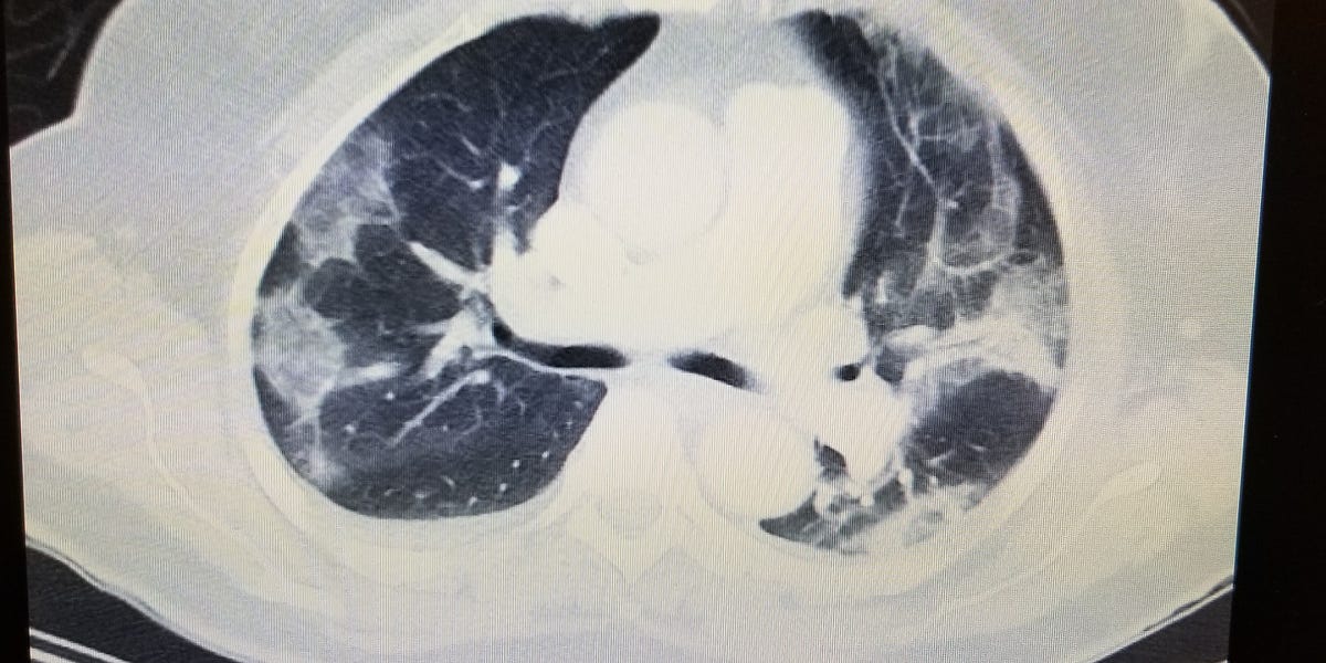 Steroids for severe pulmonary infections: Review