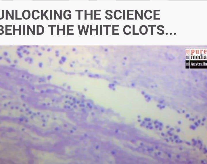 Embalmers Clots: A Scientific Review of Their Composition, Origins, and ...