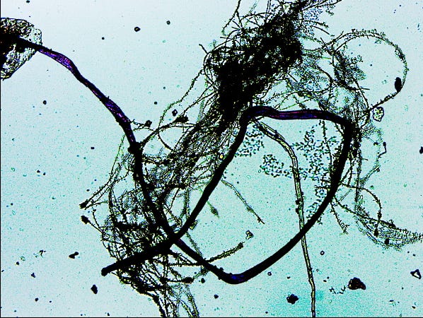 Extensive (CDB) Hydrogel Filament Growth In C19 Vaccinated and ...