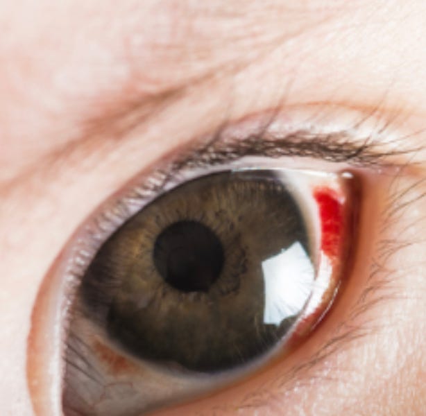 Pediatric Pearls: Infant's Eye Part 1 - Red Spots, Puffy Eyes, Big Eyes