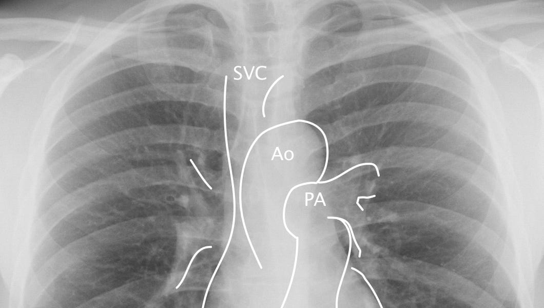 Chest anatomy - radiographs and CT - by Alexander Baxter