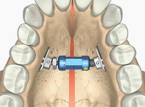 5.3 Top MARPE Devices Currently Available - JawHacks