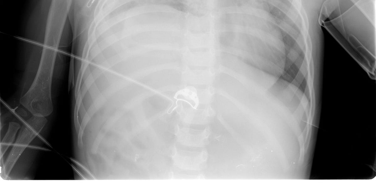 Diaphragm Rupture - RadNotes