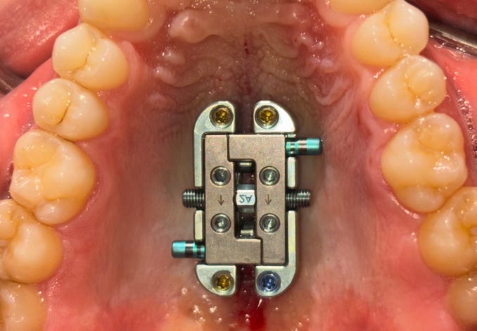 Part 2 - Dr. Newaz on FME vs. Custom MARPE - JawHacks