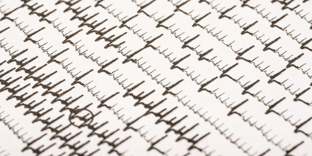 New-onset atrial fibrillation provoked by sepsis: anticoagulate or not?