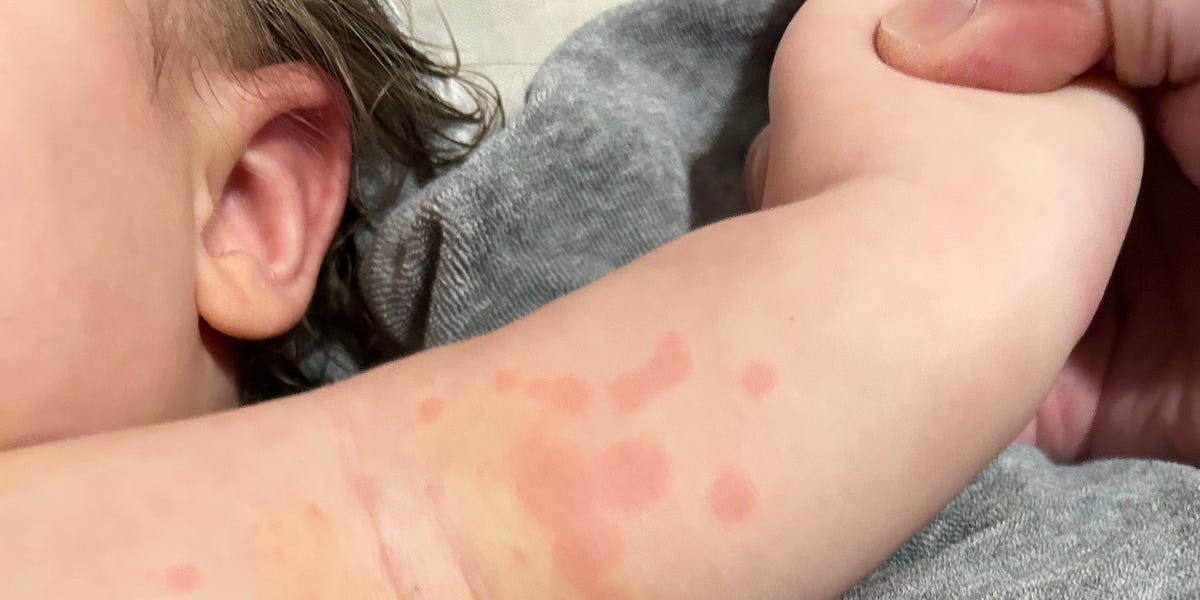 Pediatric Pearls. A Holiday Rash