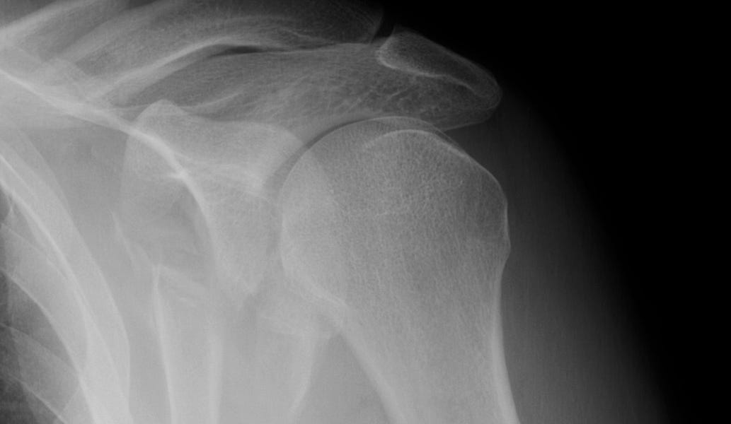 Scapular fracture - by Alexander Baxter - RadNotes
