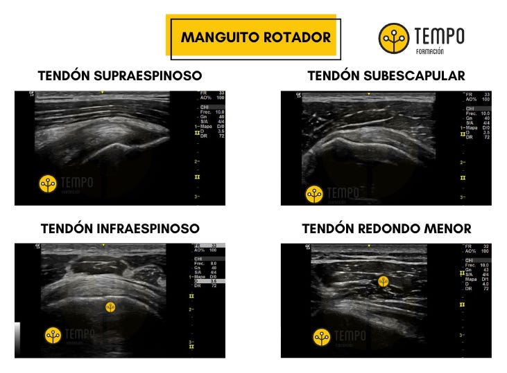Manguito rotador y ecografía - by Tempo Formación