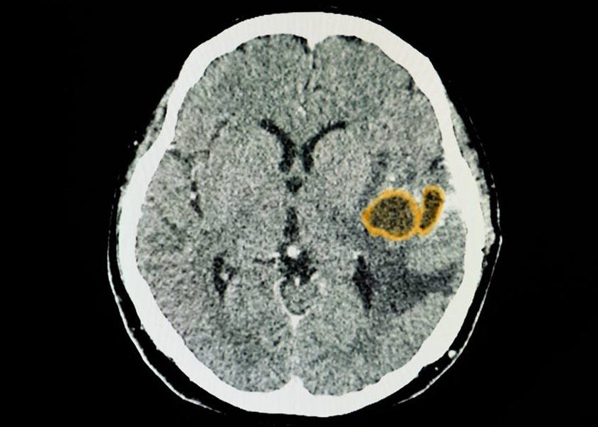 Human Brain Parasites: Don't Look Away