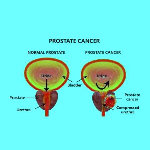Câncer de próstata: alimentado pela prolactina
