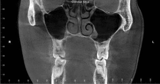 6.2 MARPE Asymmetry Problems - by Ronald Ead and Shuikai