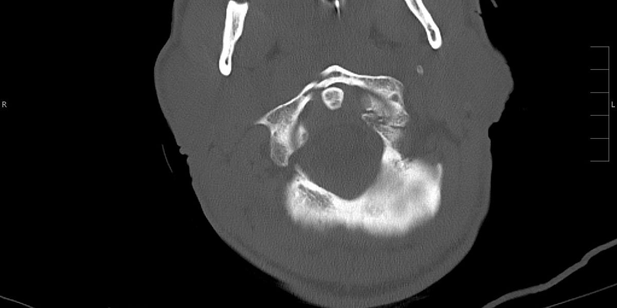 Occipital condyle fracture - by Alexander Baxter - RadNotes