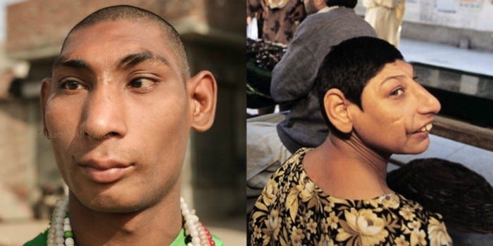 The Shrine of Abandonment: The "Rat Children" of Shah Daulah, Pakistan