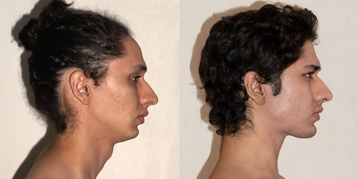 2.1 Mewing Theory: Jaw Epigenetics - by Ronald Ead