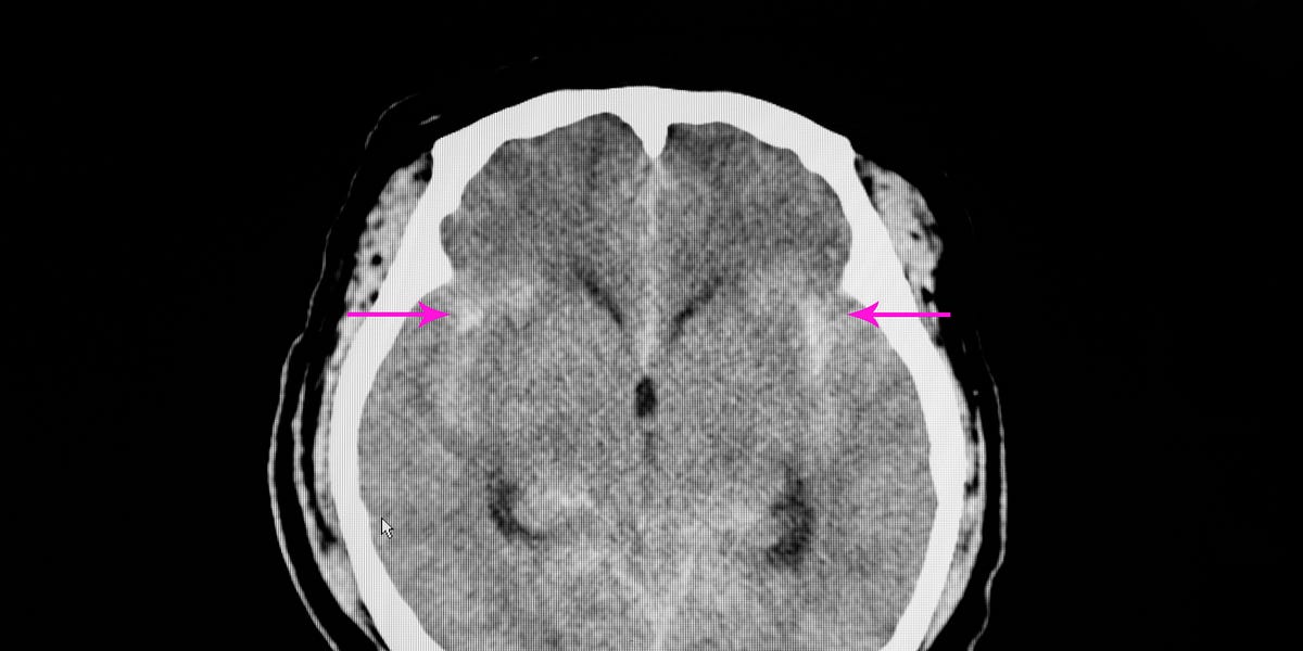 Blood transfusion targets in acute brain injury: Review (Updated)