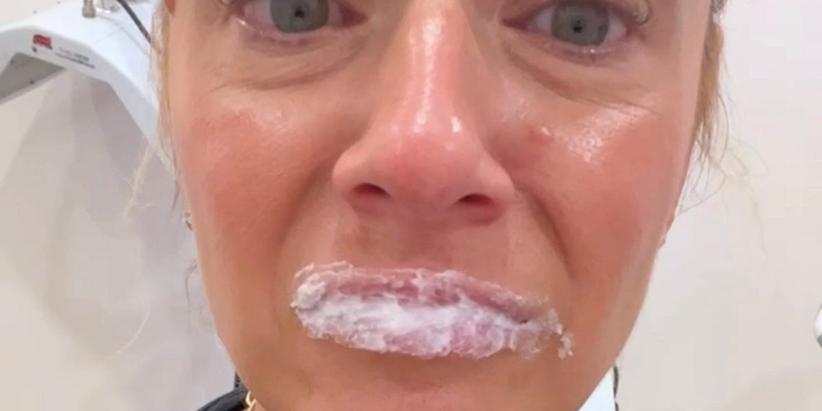 I got filler in my lips. - by Emese Gormley - Tell me more