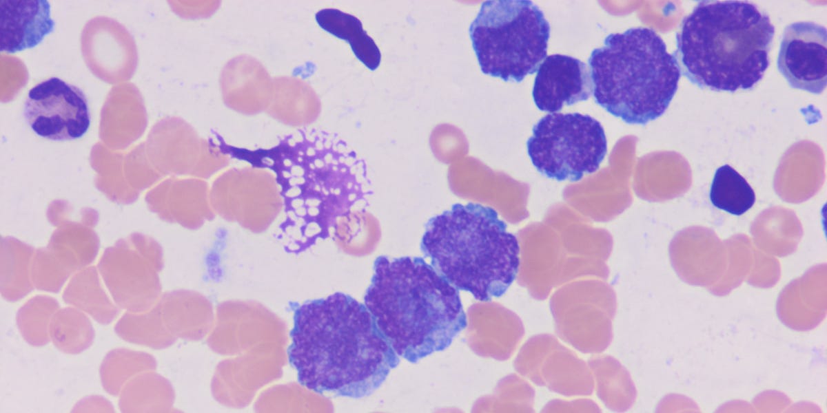 Acute myeloid leukemia with NUP98 rearrangement