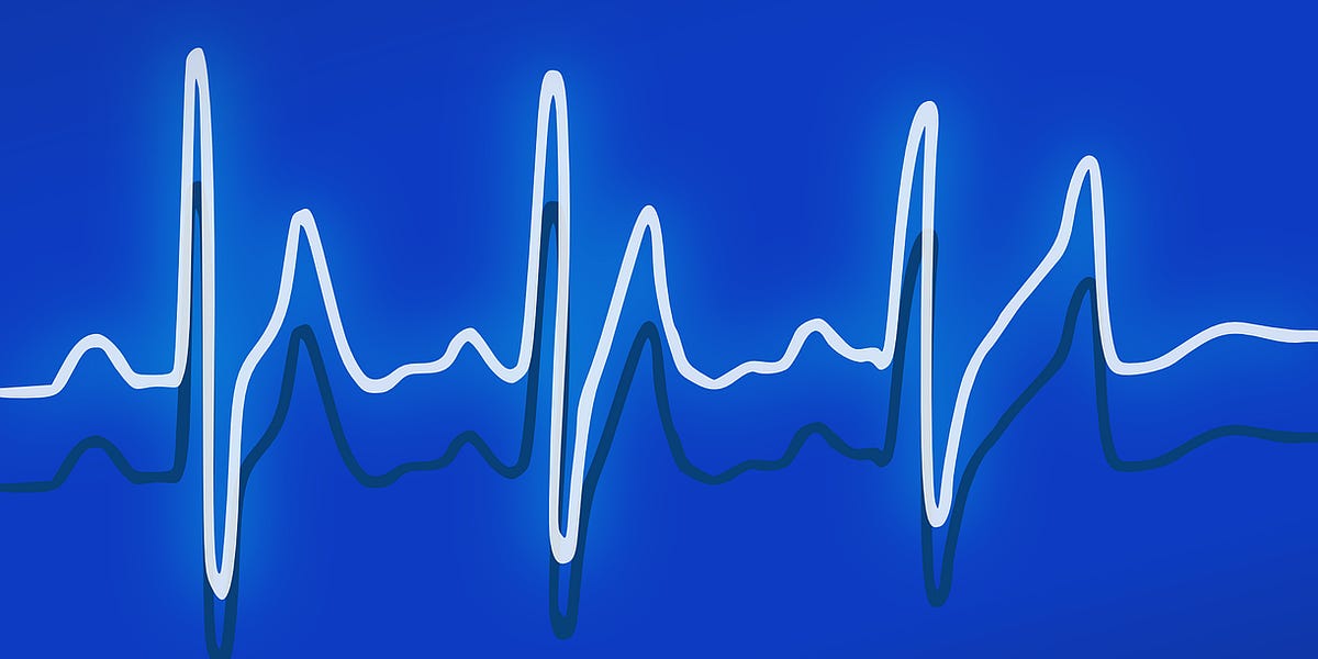 The AFFIRM Trial: Rate vs Rhythm Control in A-Fib - by Ross