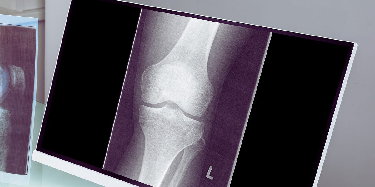 IIT Guwahati Researchers Develops AI Model to Assess Knee ...