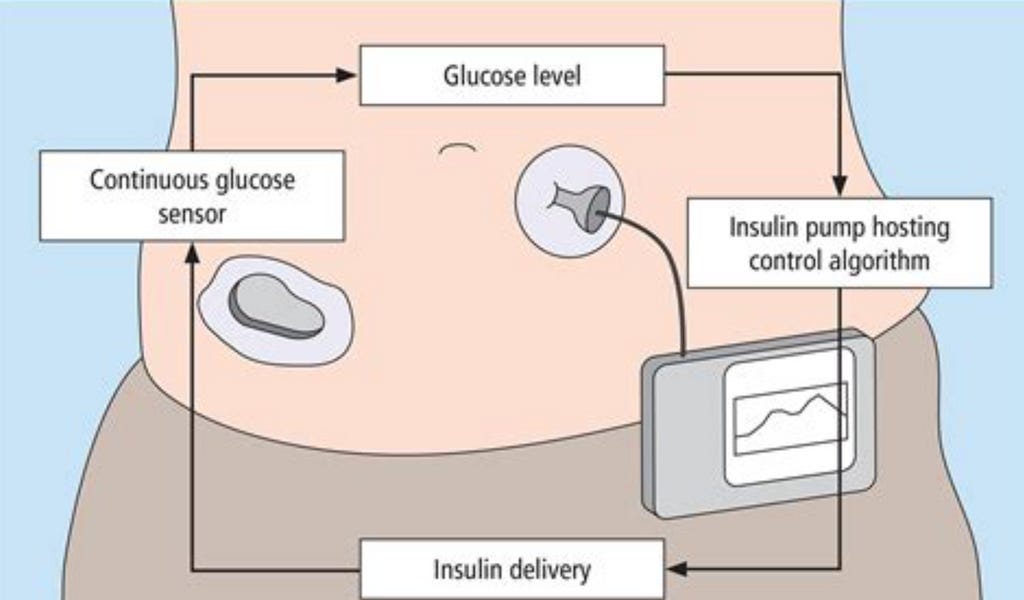 Benefits and Risks of Insulin Pumps and Closed-Loop Delivery Systems