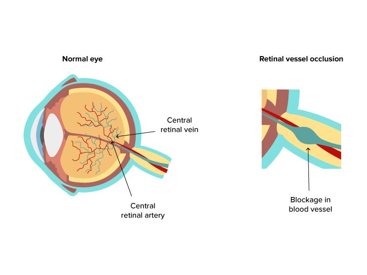 Blood clots in the eyes after COVID-19 vaccination