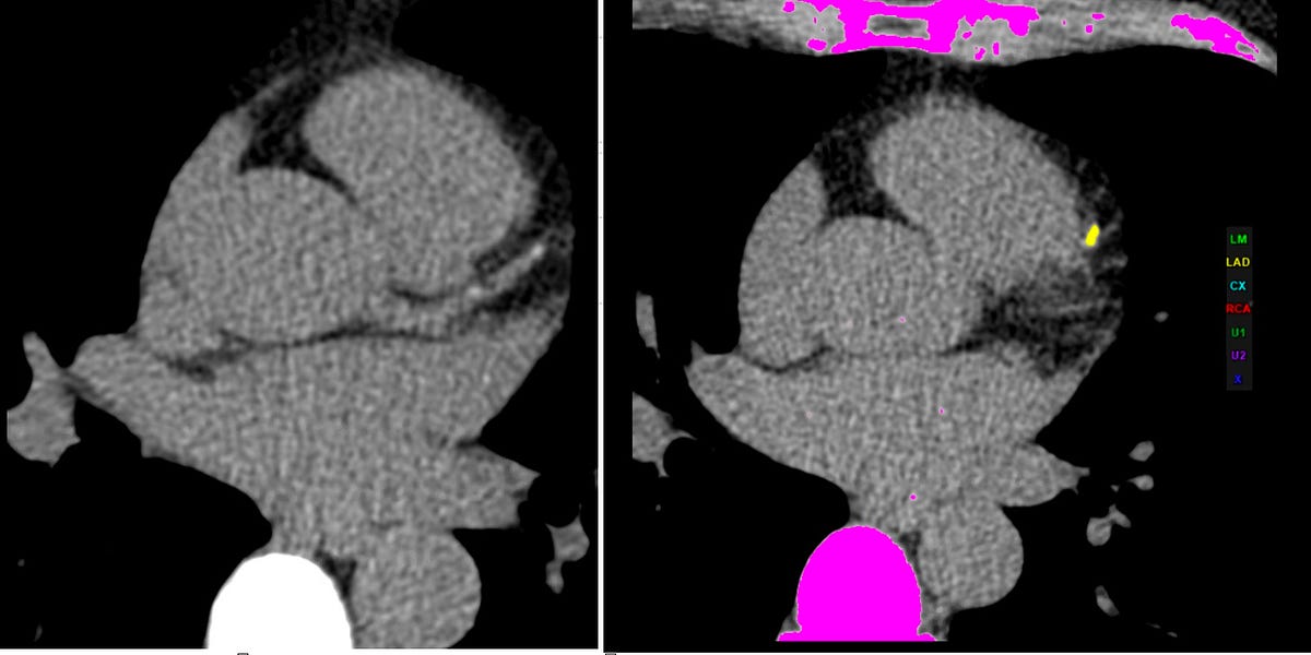 The Skeptical Cardiologist's Guide To The Coronary Artery Calcium Scan