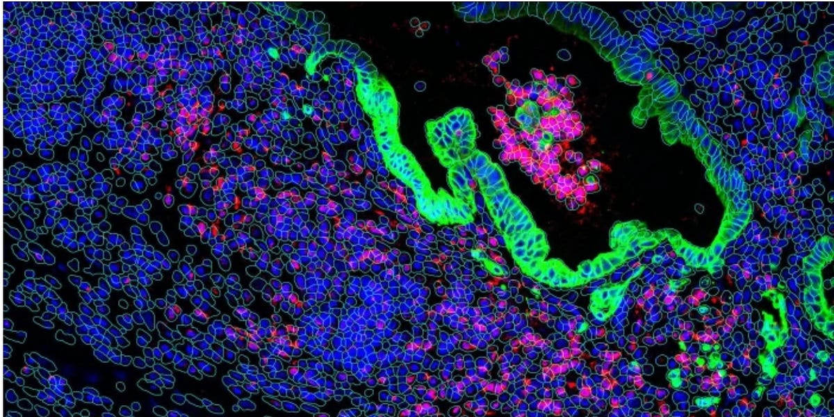 Decoding Cancer Complexity via the Largest Multi Omic Spatial Atlas