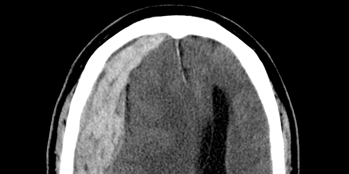 Acute Subdural Hematoma - by Alexander Baxter - RadNotes