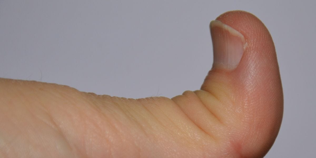 Why Do Transgender People Report Hypermobile Joints?