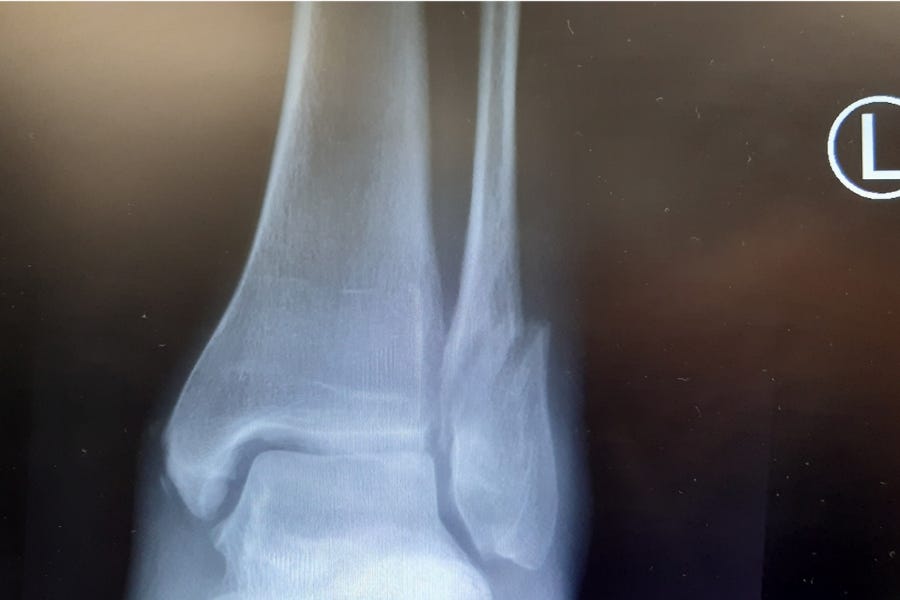 Fracture - Tony Zentelis