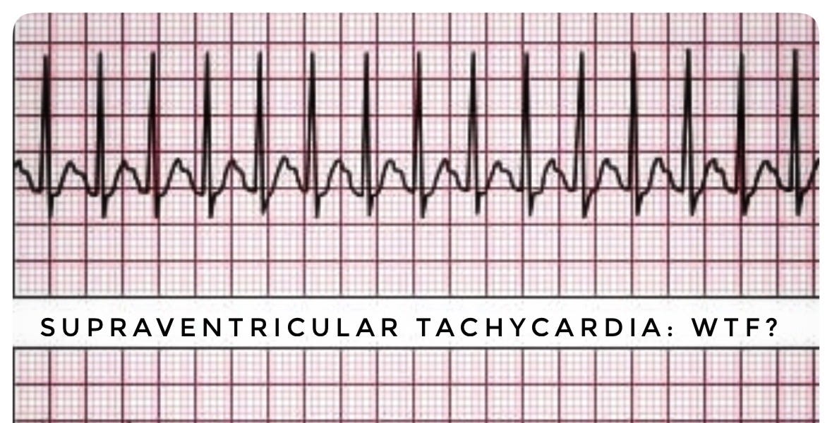 Supraventricular Tachycardia