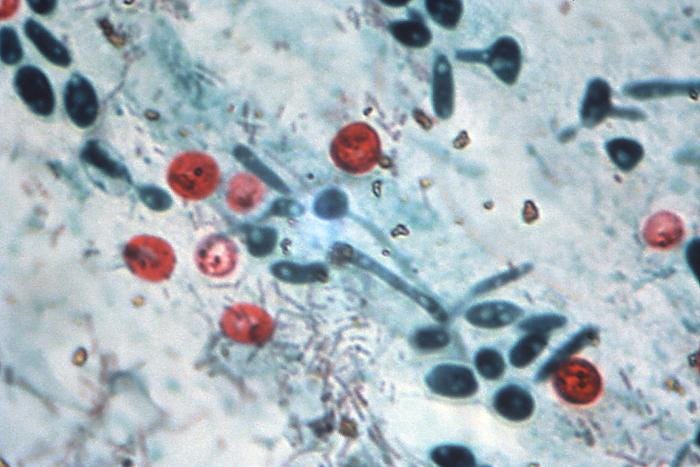 Cryptosporidium outbreak in Sweden - by Robert Herriman