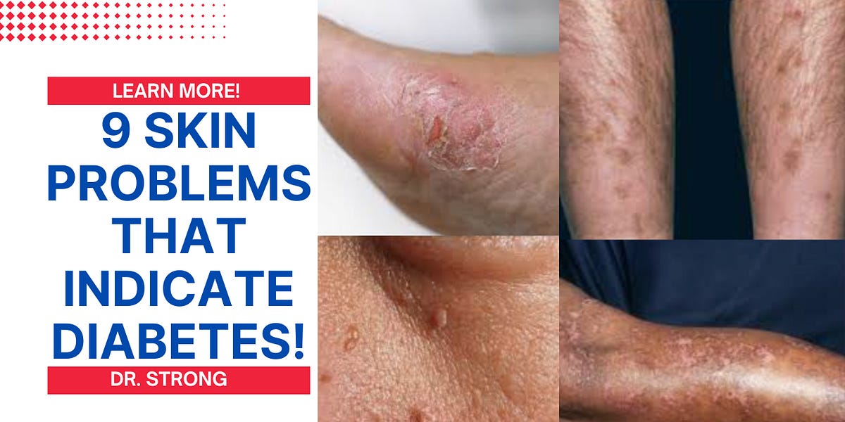 Skin Conditions Indicating Diabetes! - Dr. Strong