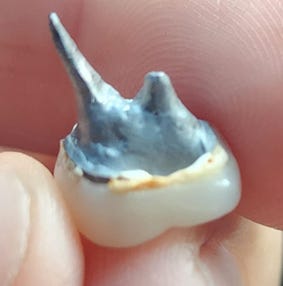 Root Canal Fillings and Their Effects