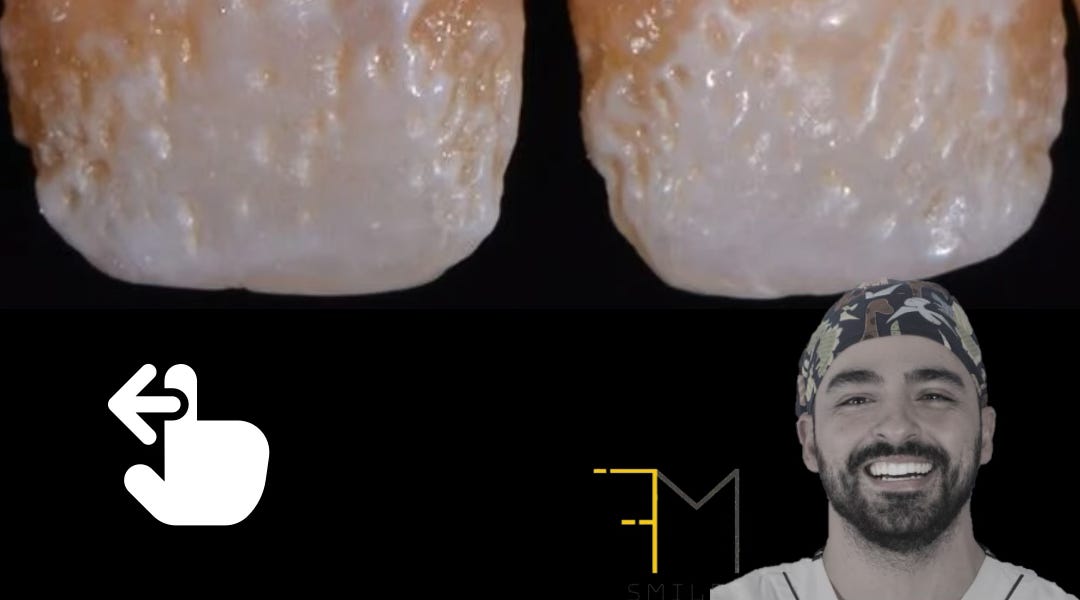 Ep.9 Amelogenesis Imperfecta